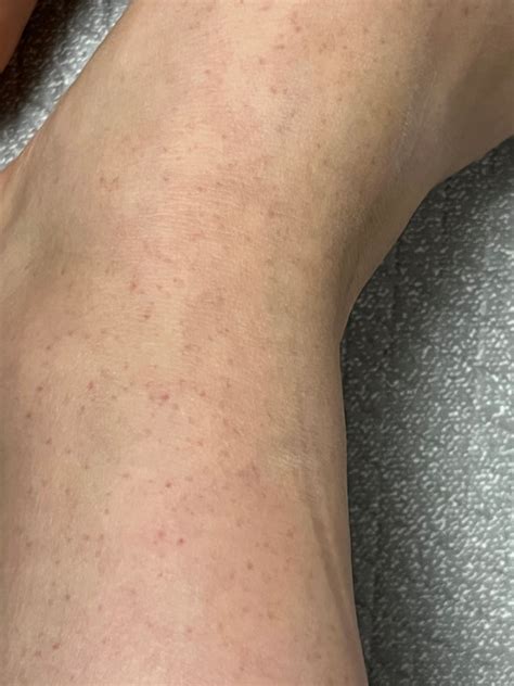 다리에 빨간 점 지식in