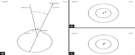 Angle Kappa And Its Importance In Refractive Surgery Oman Journal Of