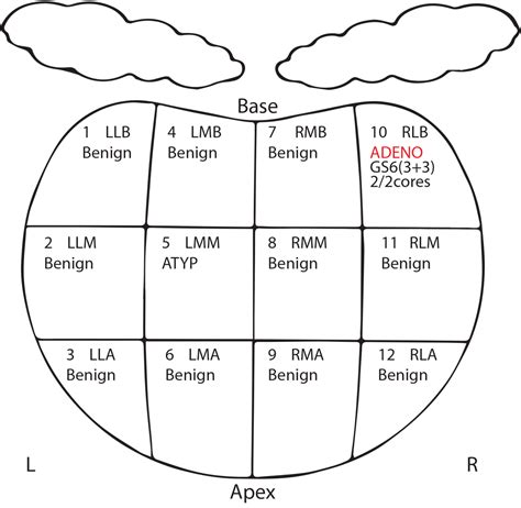 Prostate Biopsy The Urology Group