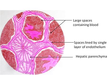 Cavernous Hemangioma Pathology Made Simple