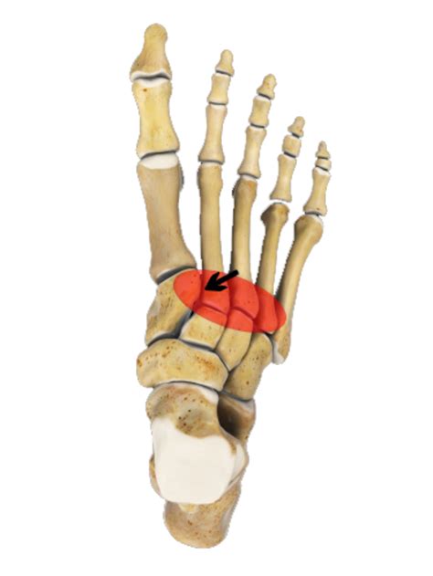 Understanding Lisfranc Injury Seek Celebrity