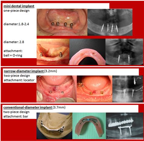 Minimally Invasive Implant Treatment Alternatives For The Edentulous