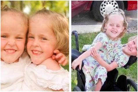 Queste Ragazze Siamesi Sono State Separate Alletà Di Quattro Anni E