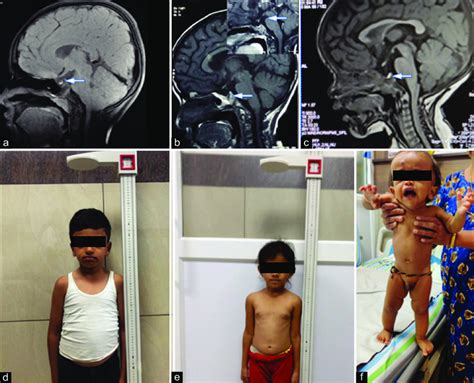 A Mri Brain T1 Weighted Sagittal View Of Case 1 Showing Hypoplastic Download Scientific