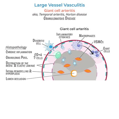 Usmle Comlex Step 1 Glossary Usmlecomlex 1 Large Vessel Vasculitis Ditki Medical