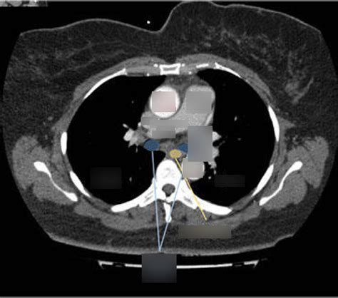 Diagram Of Ct Axial Abdo Quizlet