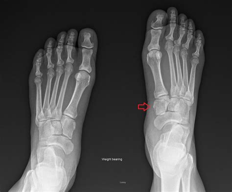 Cuneiform Bone Fracture Ct