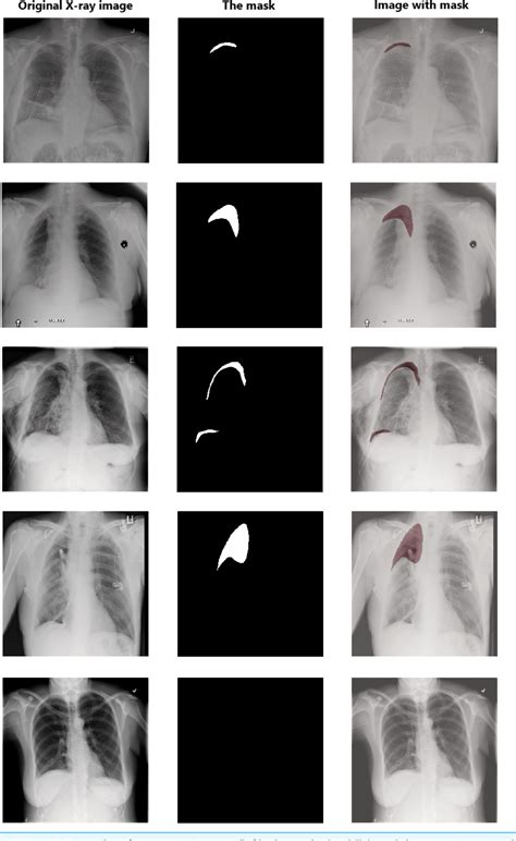 Figure 5 From Chest X Ray Pneumothorax Segmentation Using U Net With Efficientnet And Resnet