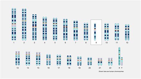 Monosomy Vs Trisomy