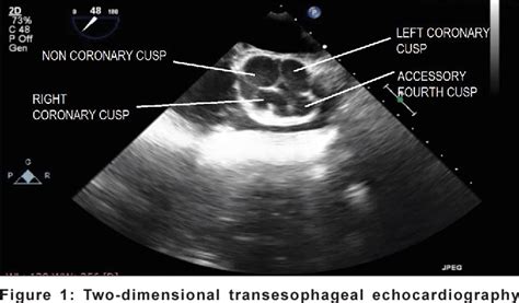 Aortic Valve Cusps Echo