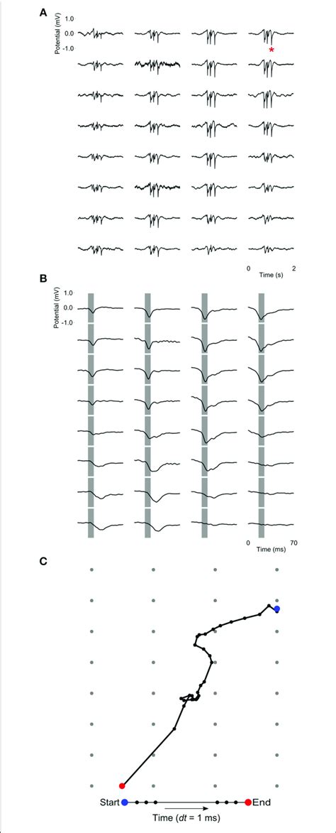 Propagating Slow Waves During Anesthesia A A 2 S Waveform Example