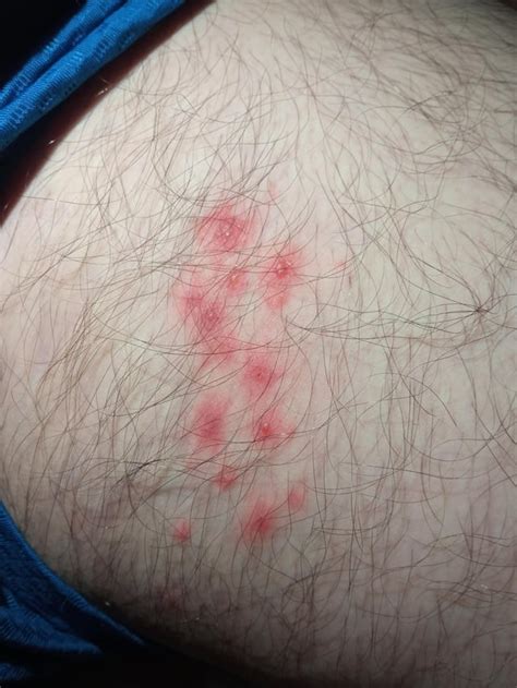 Inner Thigh Rash Due To Pads At Neal Marquez Blog