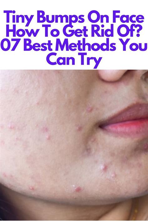 Tiny Bumps On Face How To Get Rid Of Best Methods You Can Try Small Bumps On Face Skin