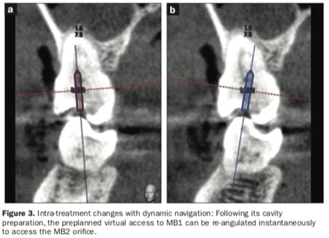 Dynamic Navigation And HUD For Endodontic Access Dentistry Today