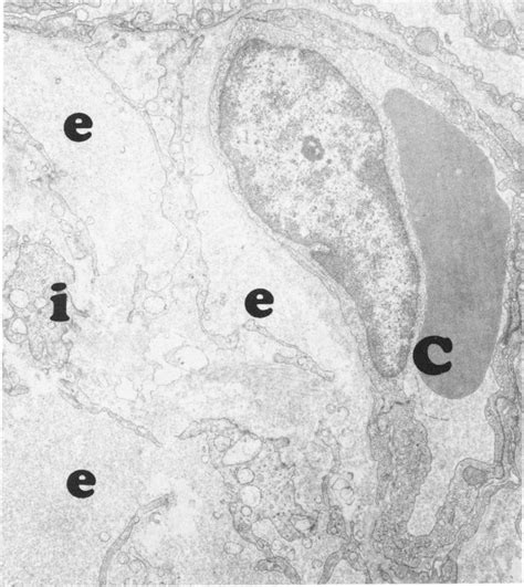 Massive Edema E Which Separates Interstitial Cells I And Collagen