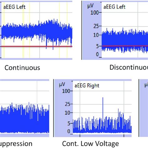 Examples Of Aeeg Background Patterns Download Scientific Diagram