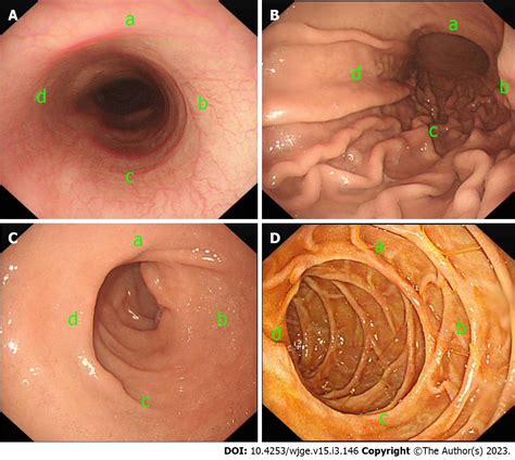 Gastric Ulcer Endoscopy