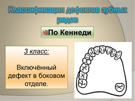 Частичная потеря зубов Online Presentation