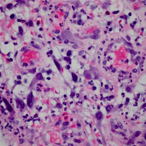 Inflammatory Pseudopolyp With Ulceration And Granulation Tissue Without Download Scientific