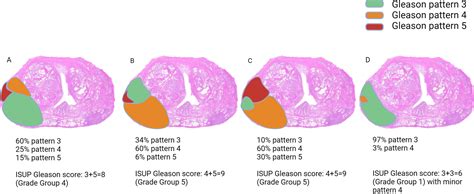 How To Report The Minor Component Of A High Grade Pattern In Radical Prostatectomy Specimens