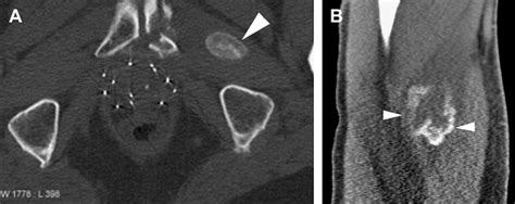 Ct Shows 2 Examples A B Of Well Defined Calcified Lesions Download Scientific Diagram