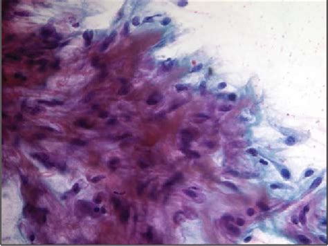 Nodular Fasciitis Semantic Scholar