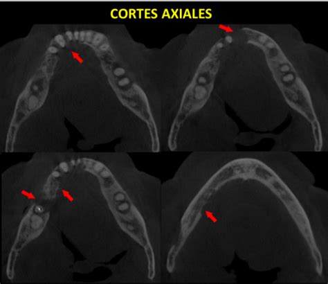 Caso N° 536 Neoplasia Maligna En Maxilar Inferior Cdi