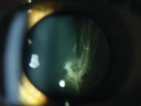 Uveitis Ento Key