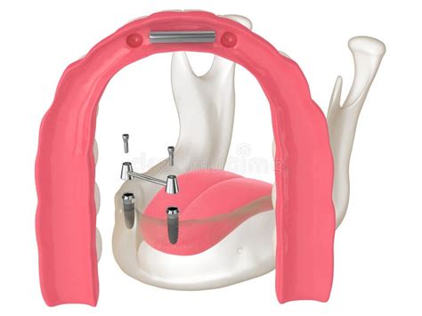 3d Render Of Removable Overdenture Installation On Bar Clip Attachment Supported By Implants