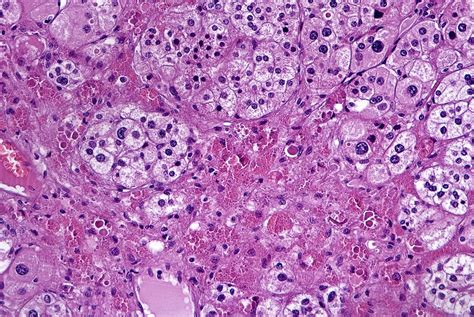 Pathology Outlines Adrenal Cortical Adenoma