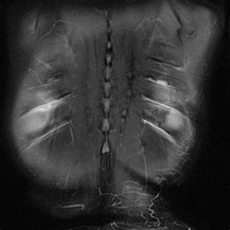 Compva Syndromes With Lymphatic Malformation