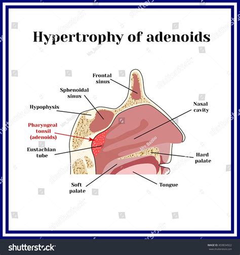 Adenoids
