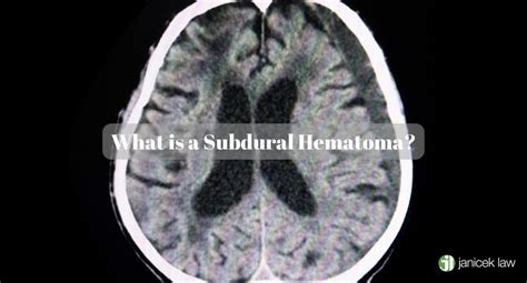 How To Prevent Subdural Hematoma Ask The Nurse Expert