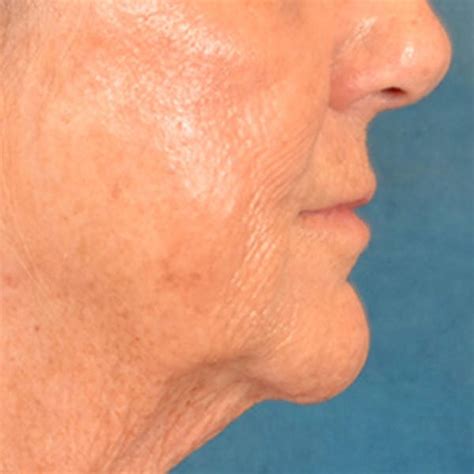 Patient 139841 Before And After Gallery Dr Sidney Starkman