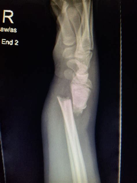 Forearm Fracture Cast Position At Shanita Parker Blog