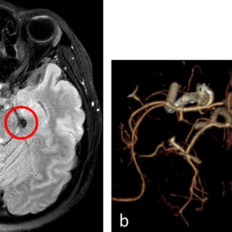 A The Patients Flair Sequence Of Brain Mri A Saccular Flow Void Is