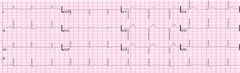 How Does An Anteroseptal Infarct Affect The Body Vgsh