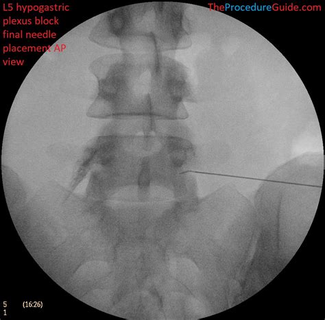 Hypogastric Plexus Block Technique And Overview The Procedure Guide