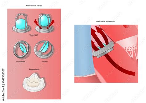 Artificial Heart Valve