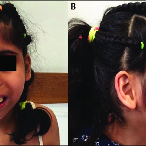 A B Photographs Of The Patient Note The Triangular Face