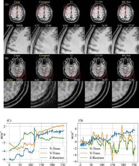 Figure 6 From Motion Correction For Brain Mri Using Deep Learning And A Novel Hybrid Loss