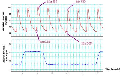 Determination Of Systolic Pressure Variation Download Scientific Diagram