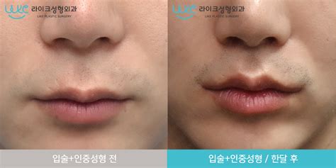 라이크성형외과 전후사진