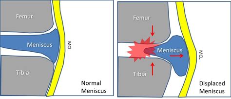 Medial Meniscus Location