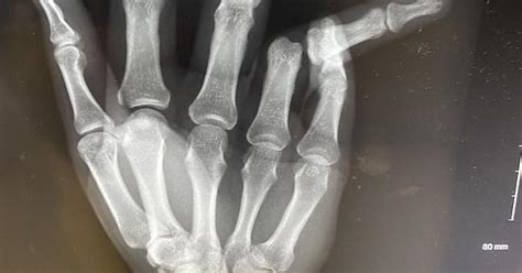 Finger Dislocation Album On Imgur