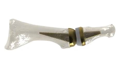 Anatomic Implants And Addup To Develop Toe Joint Replacement Implants