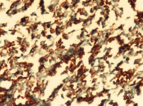 Atypical Large Diffuse Lymphocytic Infiltration Is Seen In Case 3