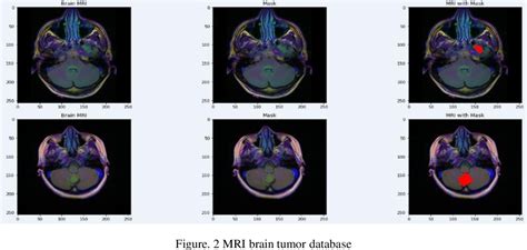 Figure 2 From Brain Tumor Classification For Mr Images Using Convolution Neural Network With