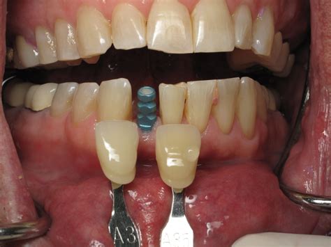 Root Canal Front Bottom Tooth