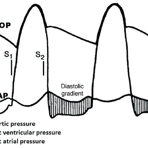 Physiopathology Of Mitral Stenosis Demonstrating The Diastolic Download Scientific Diagram